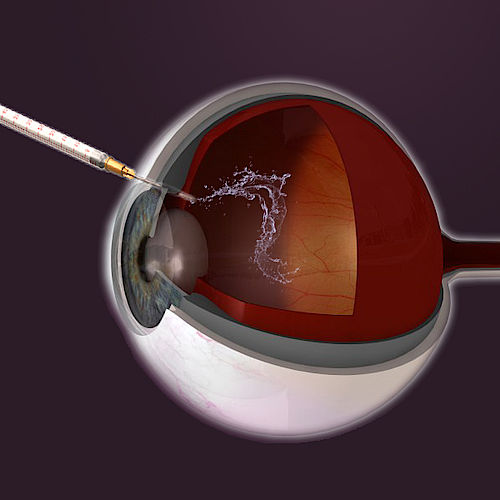 Intravitreal Injection – Paulig Eye & Health